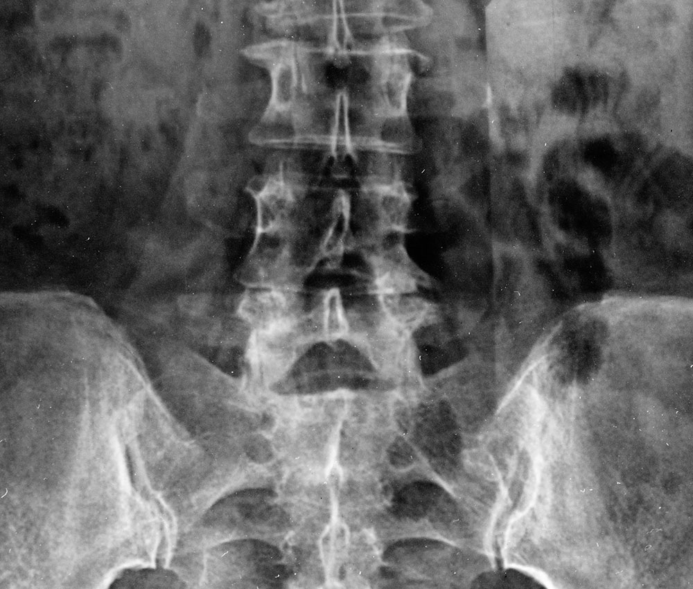 Microdiscectomy | Gulf Coast Brain and Spine Center