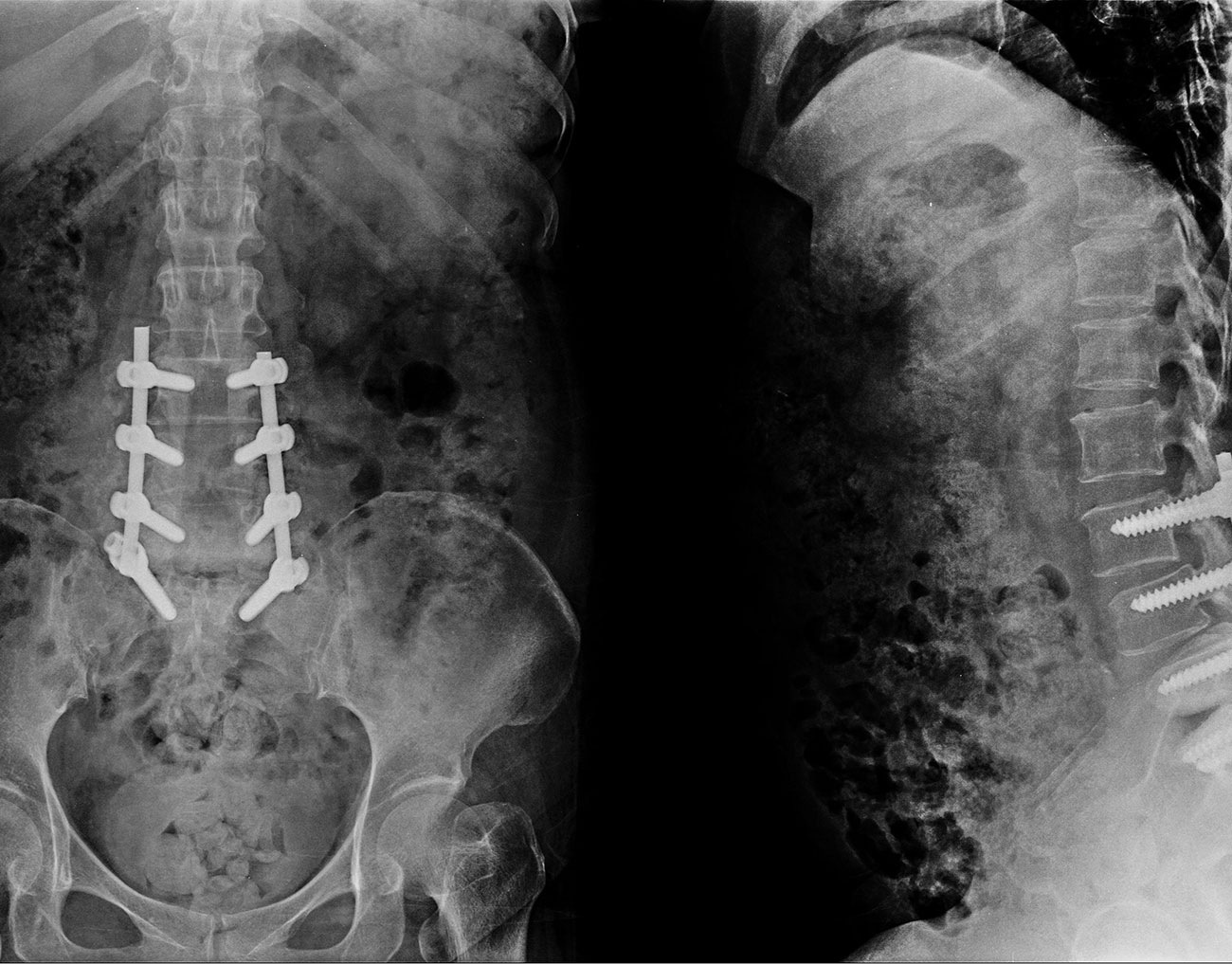Failed Back Syndrome | Gulf Coast Brain and Spine Center